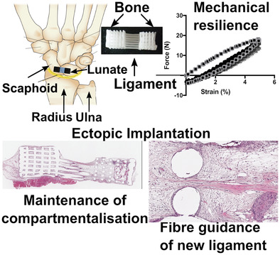 Artificial Ligaments to Repair Common Sports Injuries - Advanced ...