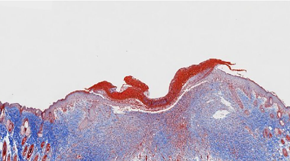 An engineered skin accelerates healing in severe and chronic wounds ...