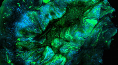 Light-activated therapy and antibiotics join forces to improve in situ ...